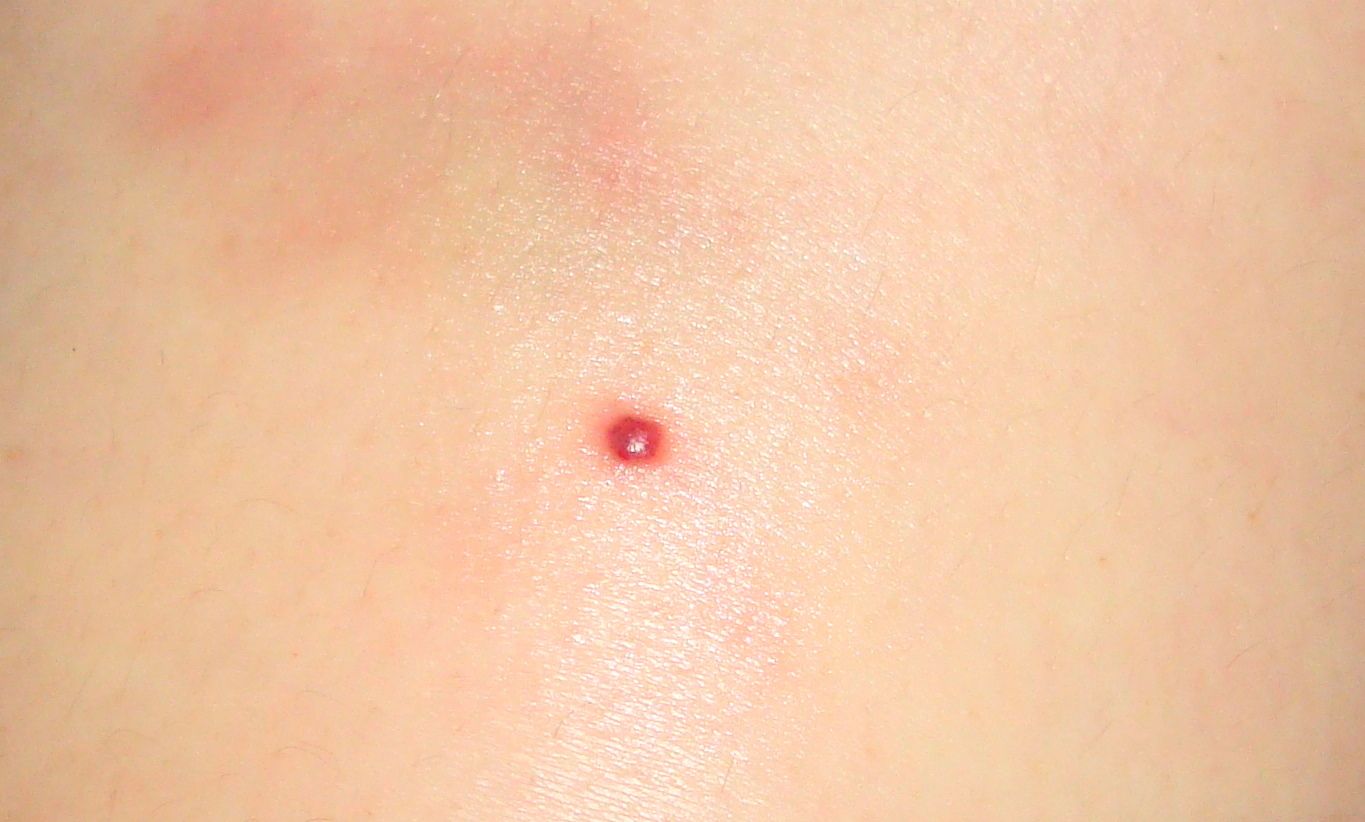 ¿Por qué aparecen los lunares rojos de la piel? - Clinicasesteticas.cl ...