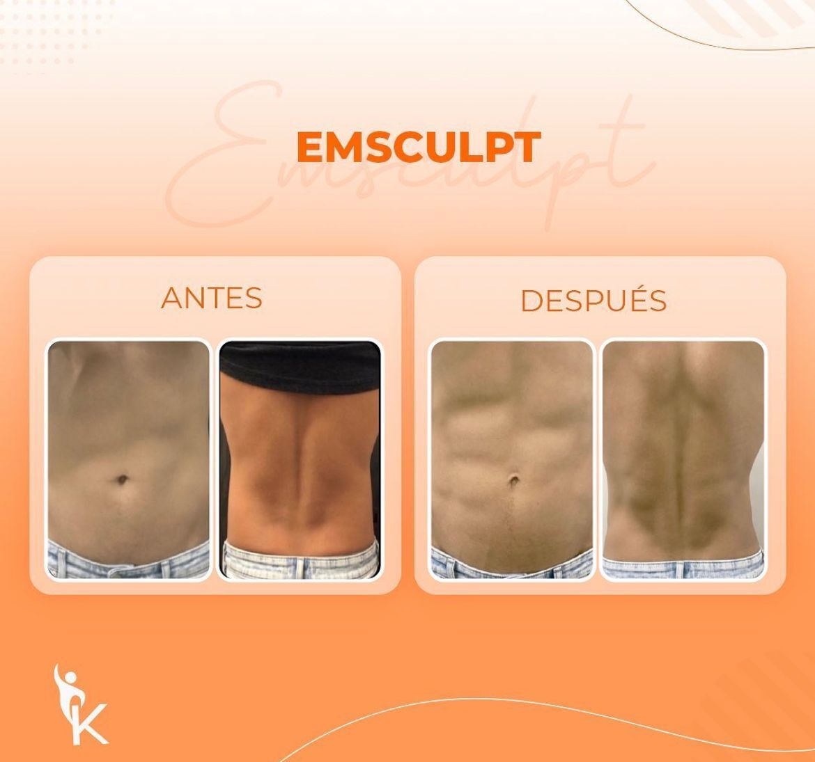 Radiofrecuencia Antes y después - Clinicasesteticas.cl ...