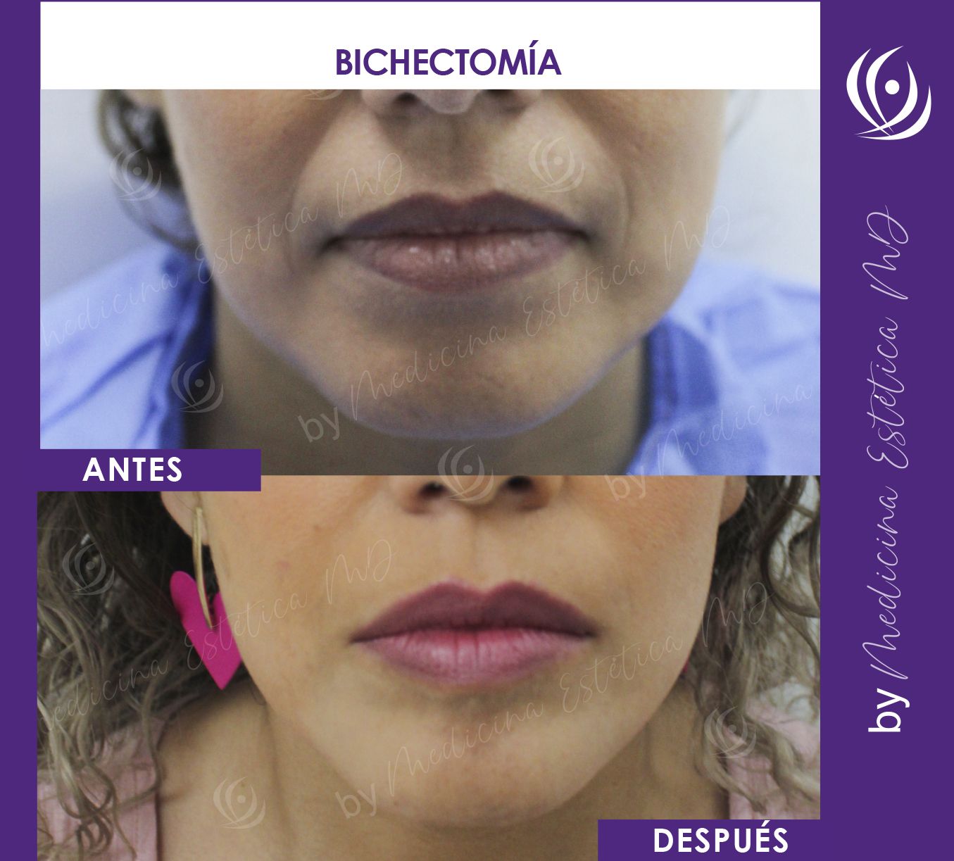 Bolas de Bichat Antes y después - Clinicasesteticas.cl