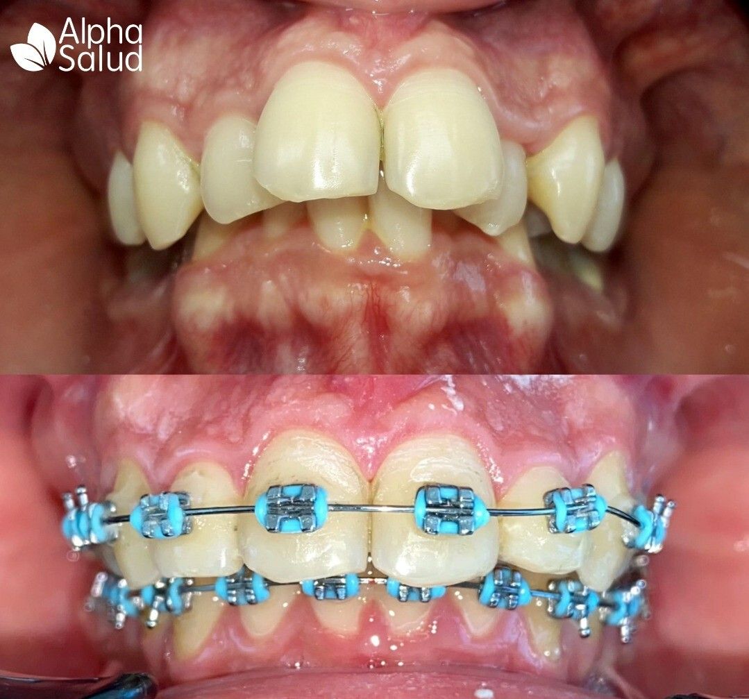Brackets Antes y después - Clinicasesteticas.cl - Clinicasesteticas.cl