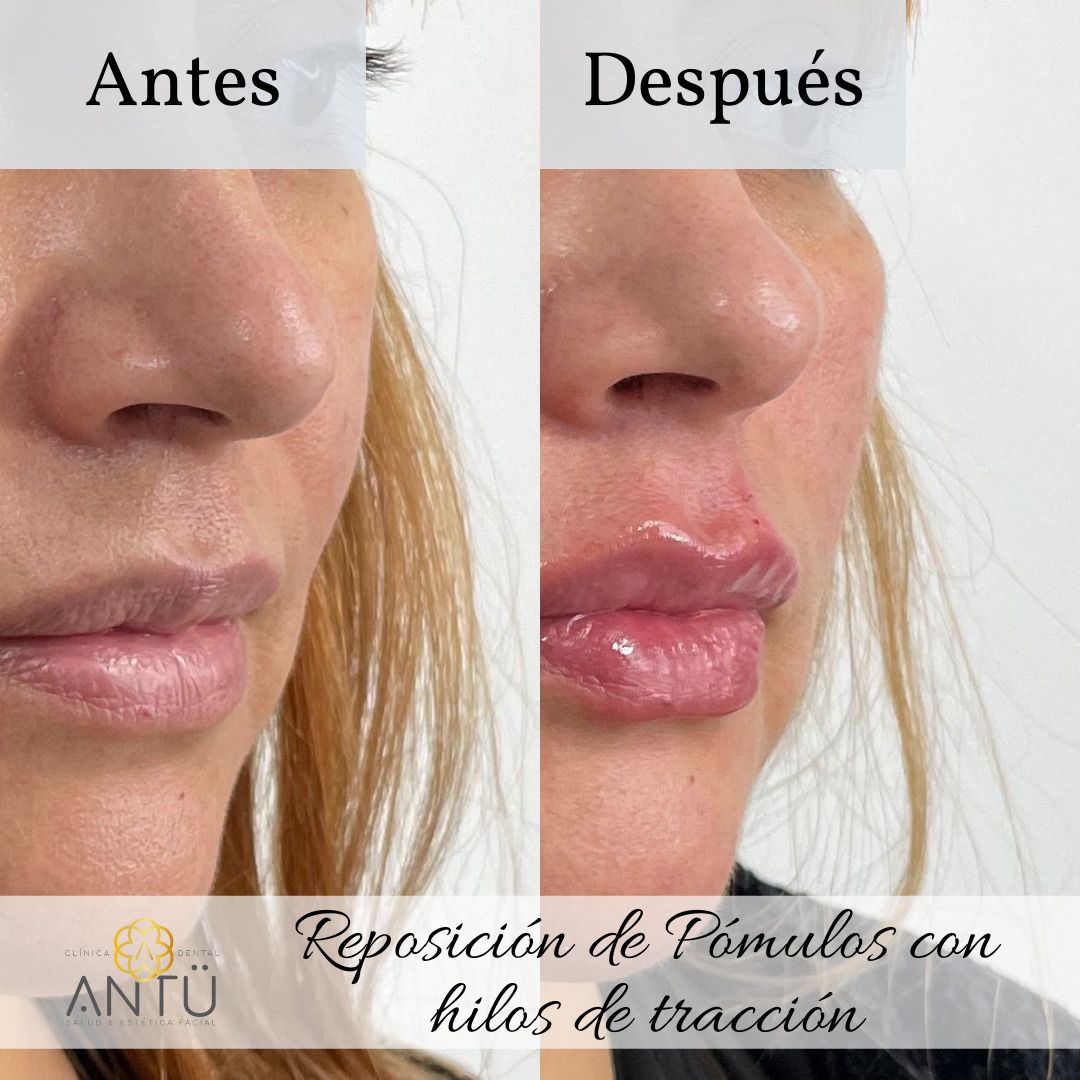 Aumento de pómulo Antes y después - Clinicasesteticas.cl