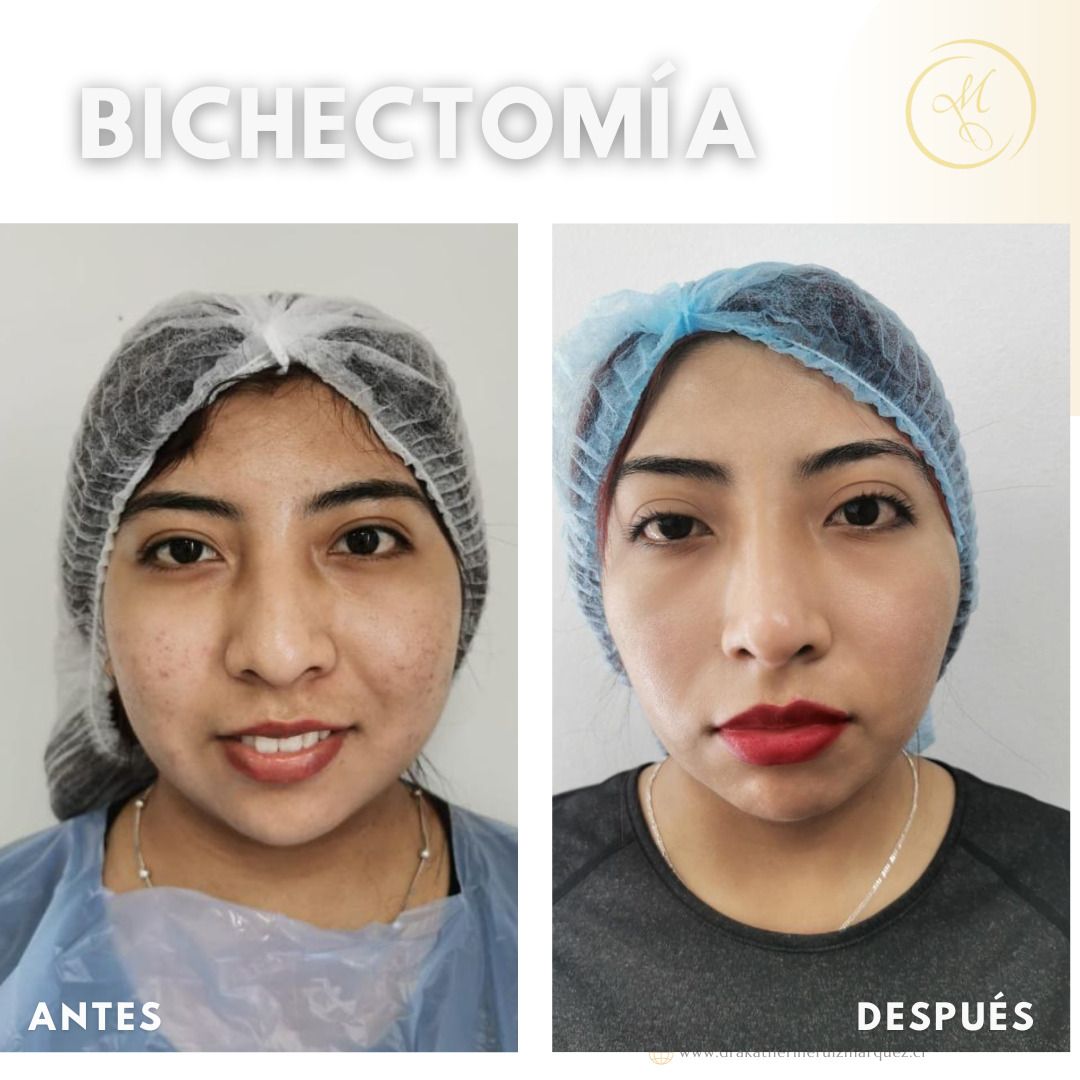 Bolas de Bichat Antes y después - Clinicasesteticas.cl
