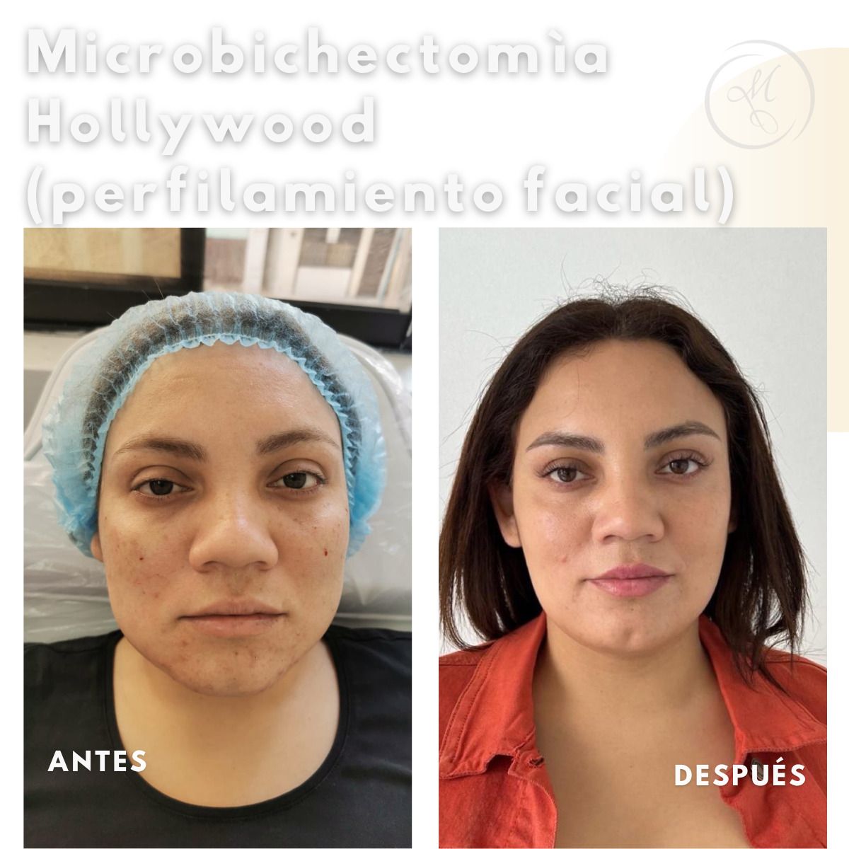 Bolas de Bichat Antes y después - Clinicasesteticas.cl