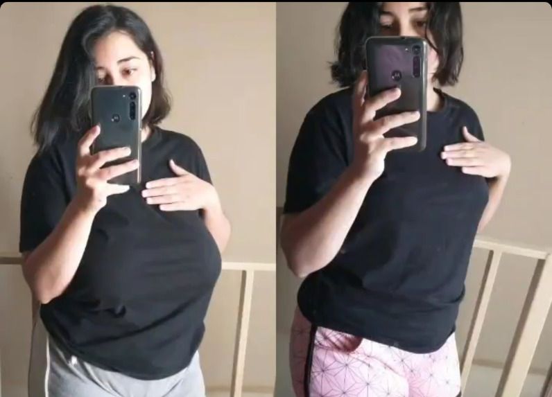 A 2 meses de una Reducción Mamaria - Reducción mamaria ...