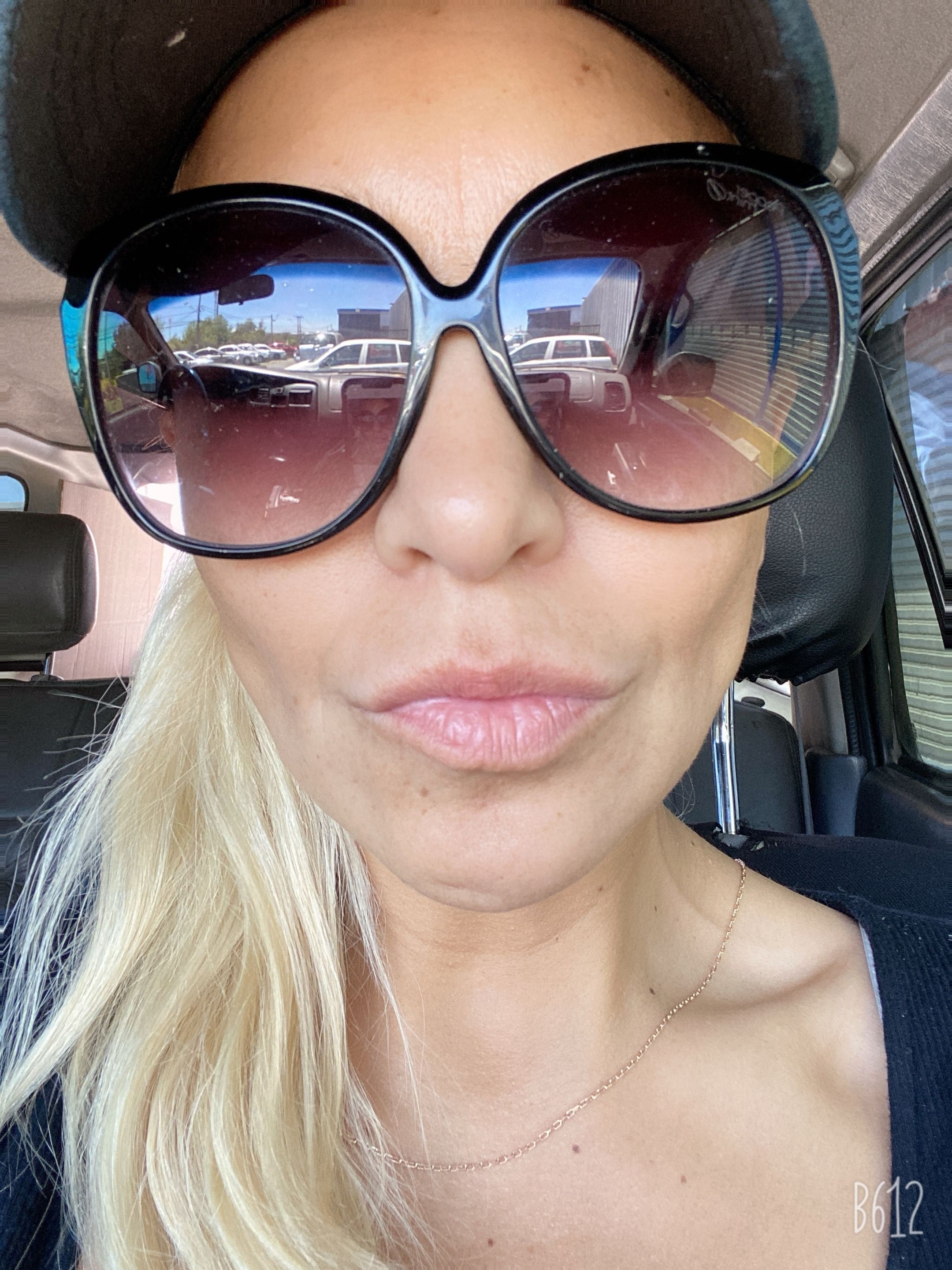 Bolas de bichat: perfecta recuperación - Bolas de Bichat - Clinicasesteticas.cl