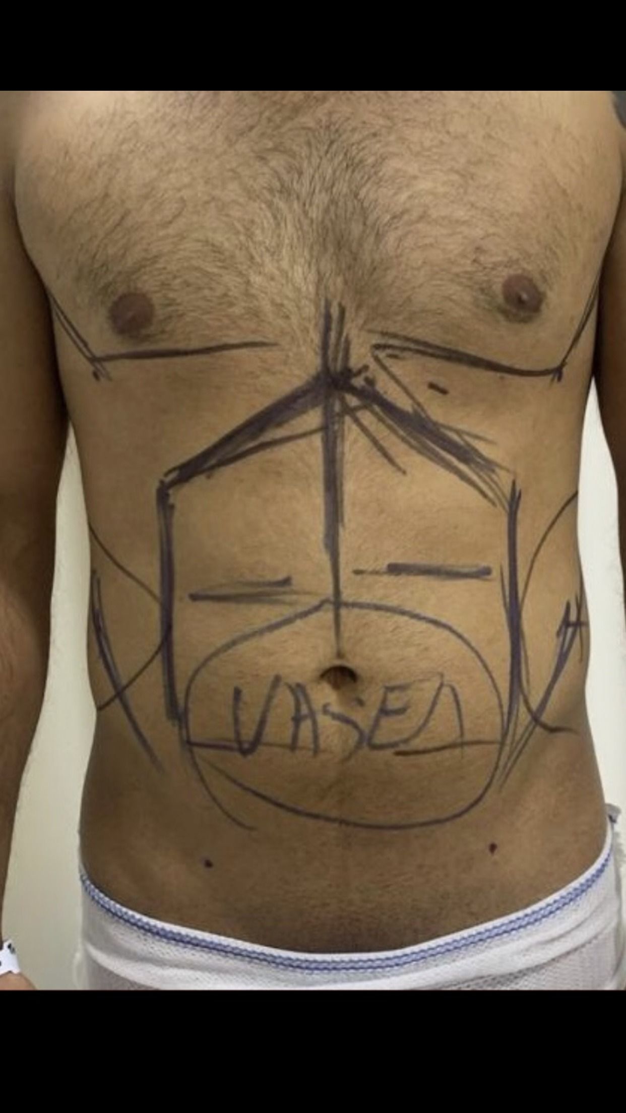 Lipomarcacion Abdominal en hombres - Lipoescultura - Clinicasesteticas.cl