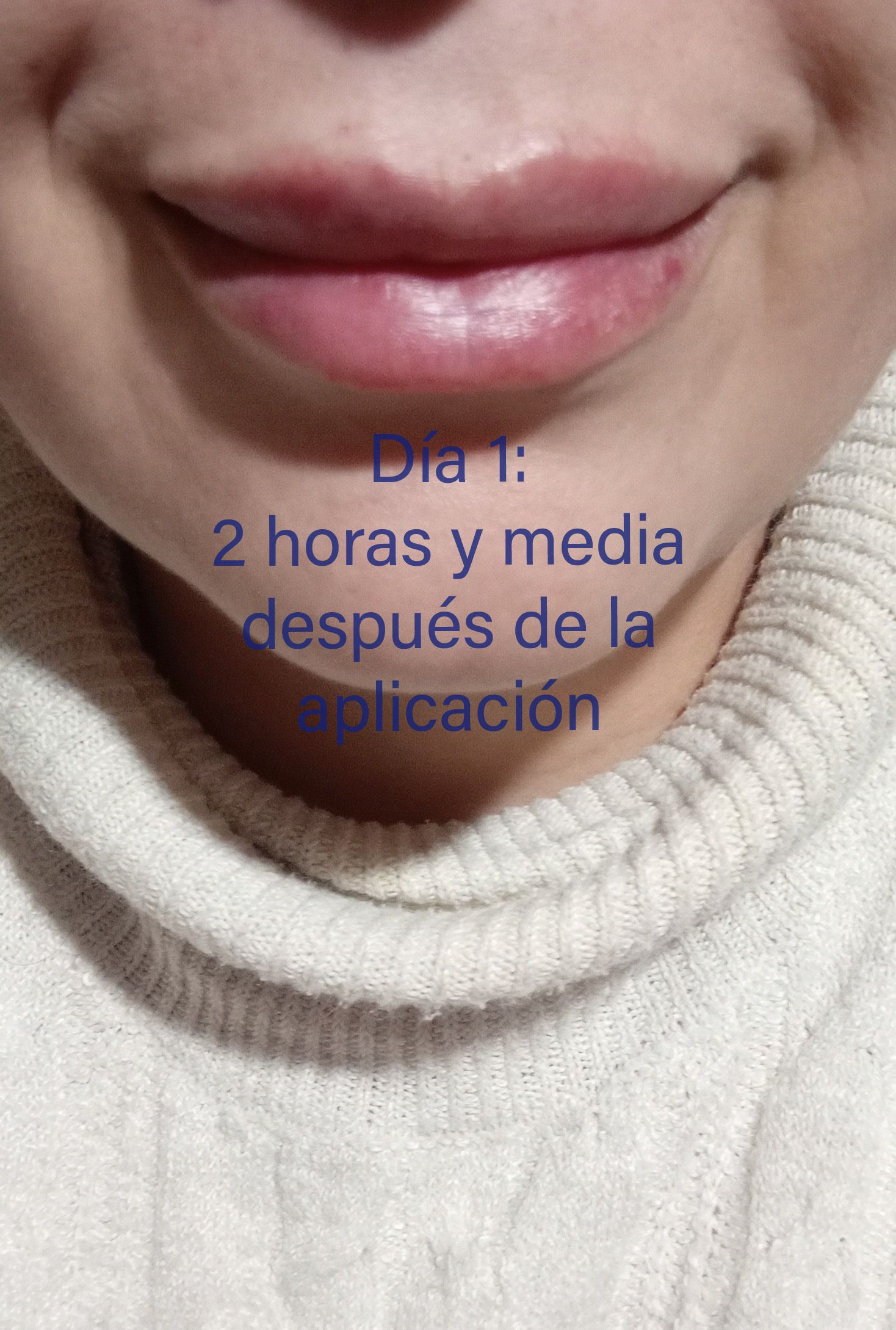 Excelente experiencia Dermodent - Javiera Campusano - Aumento de labios ...