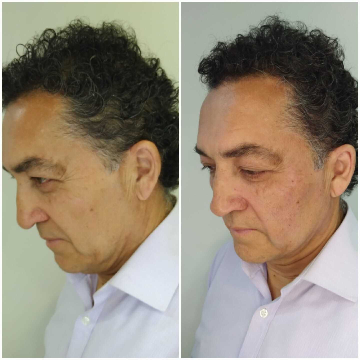 Relleno con Botox para contorno de ojos, boca y en la frente. - Bótox ...