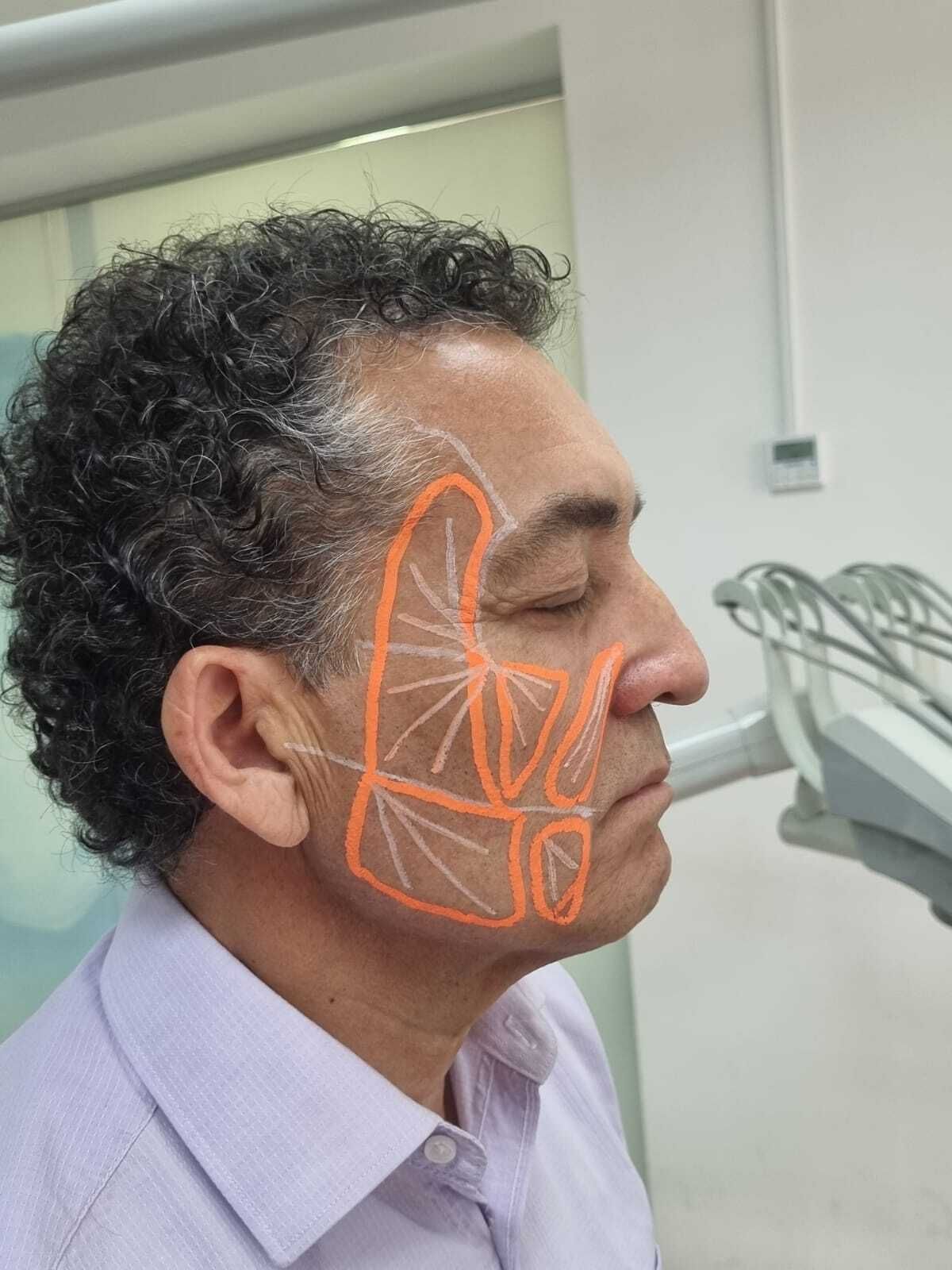 Relleno con Botox para contorno de ojos, boca y en la frente. - Bótox ...