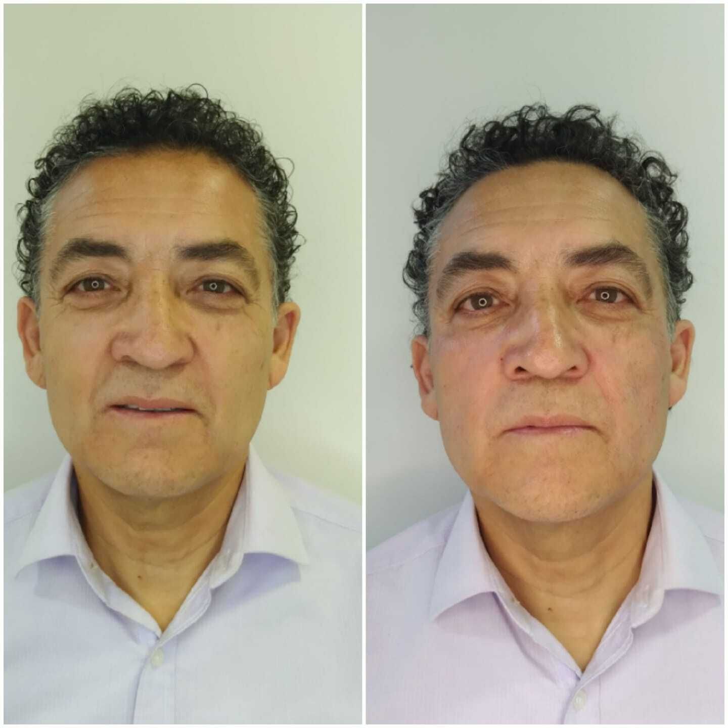 Relleno con Botox para contorno de ojos, boca y en la frente. - Bótox ...