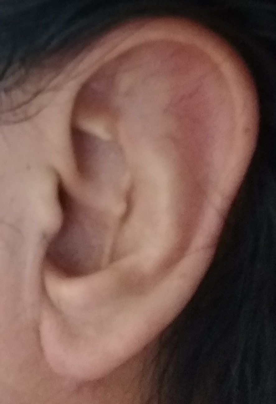 Orejas demasiado pegadas luego de otoplastia - Otoplastia ...