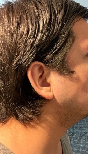 Otoplastia por orejas alargadas y grandes, no abiertas ...