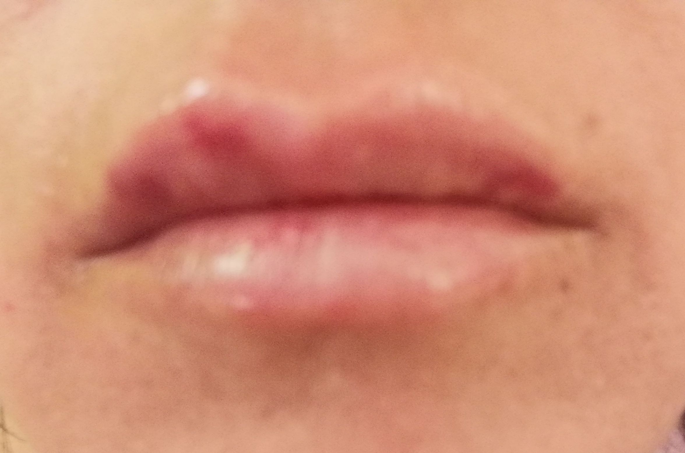 Hematoma e inflamación labial por aplicación de ácido hialuronico ...